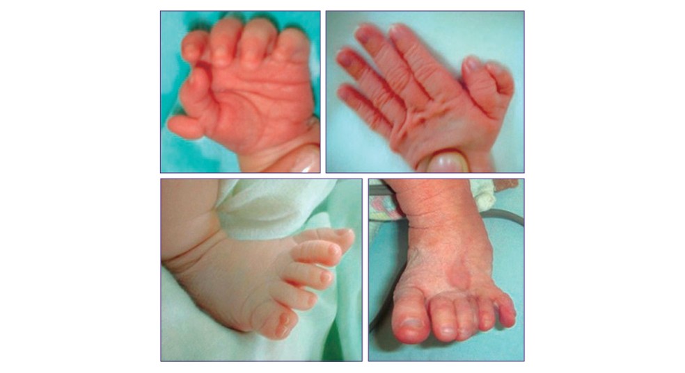 Marvvila do BBB revela que tem polidactilia; entenda o que é - Portal 98 FM Natal